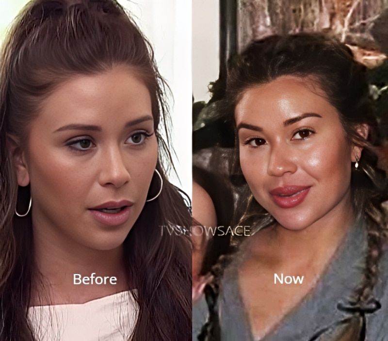 ‘Bachelorette’ Gabby Windey Feared Death Amid Bad Botox Reaction ...